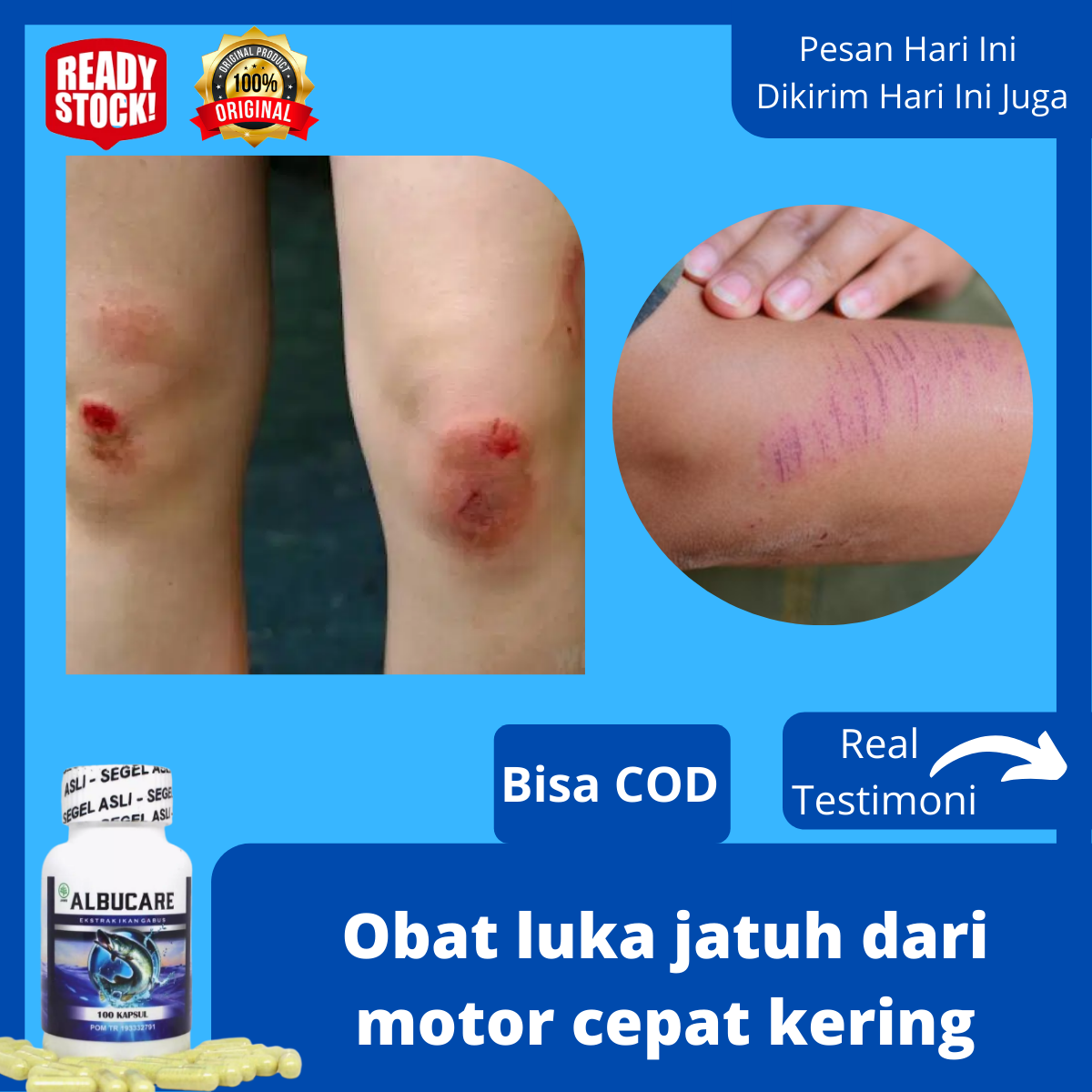 Gambar Luka Jatuh Dari Motor - 58+ Koleksi Gambar Gambar Luka Jatuh Dari Motor - 58+ Koleksi Gambar