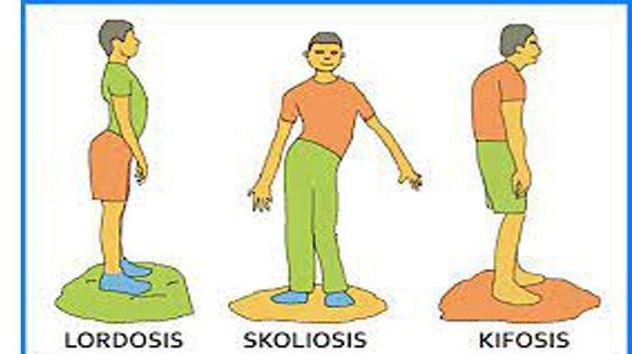 Detail Gambar Skoliosis Lordosis Dan Kifosis Koleksi Nomer 31 Detail Gambar Skoliosis Lordosis Dan Kifosis Koleksi Nomer 31