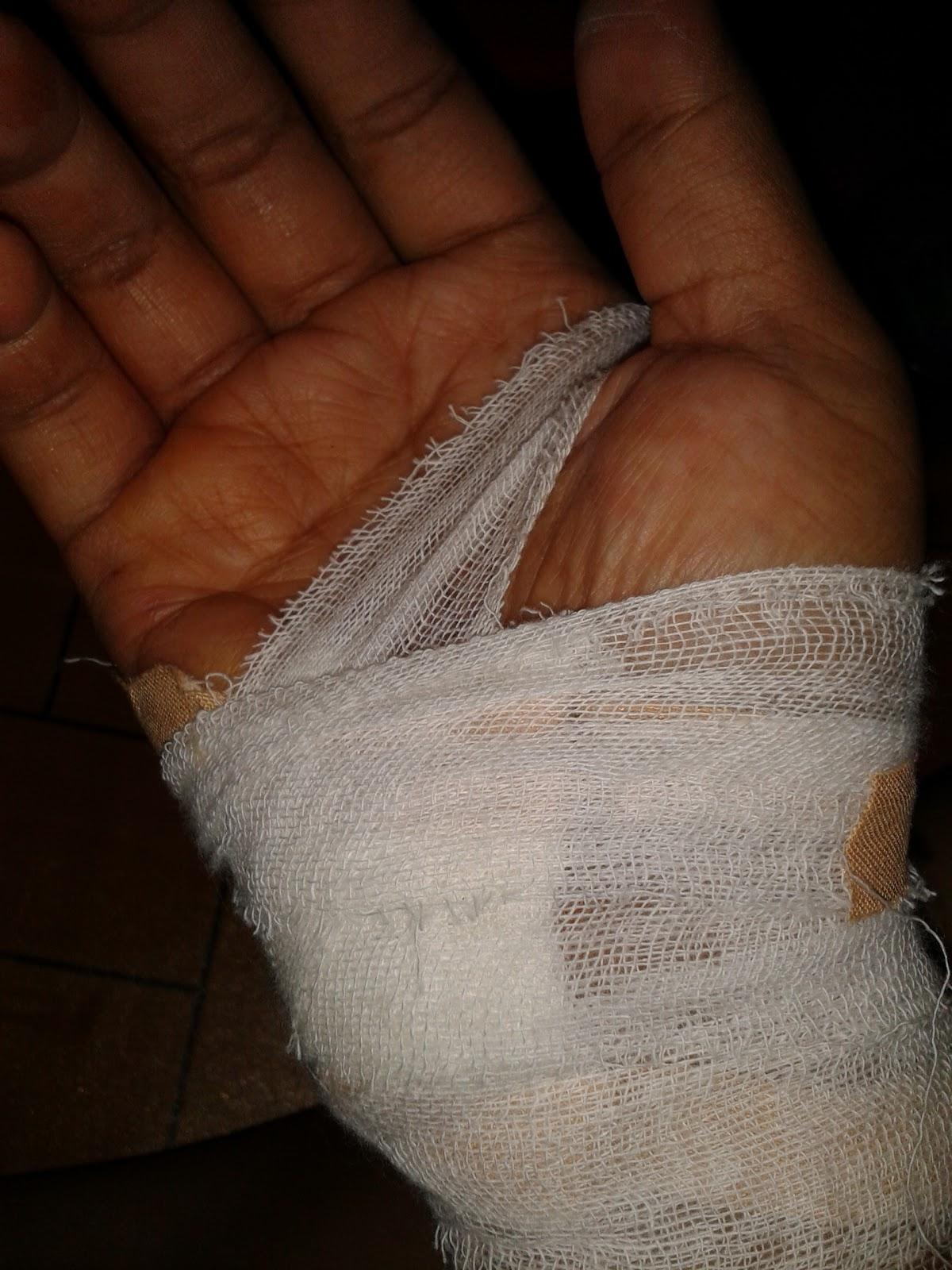 Halaman Unduh untuk file Gambar Tangan Di Perban Karena Luka yang ke 8 Halaman Unduh untuk file Gambar Tangan Di Perban Karena Luka yang ke 8